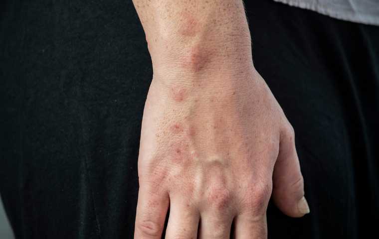 How Long Do Bed Bug Bites Last? | Miche Pest Control